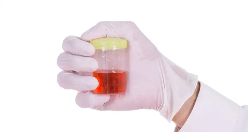 Blut im Urin bei Prostatakrebs: Ursachen, Symptome, Diagnose und ...